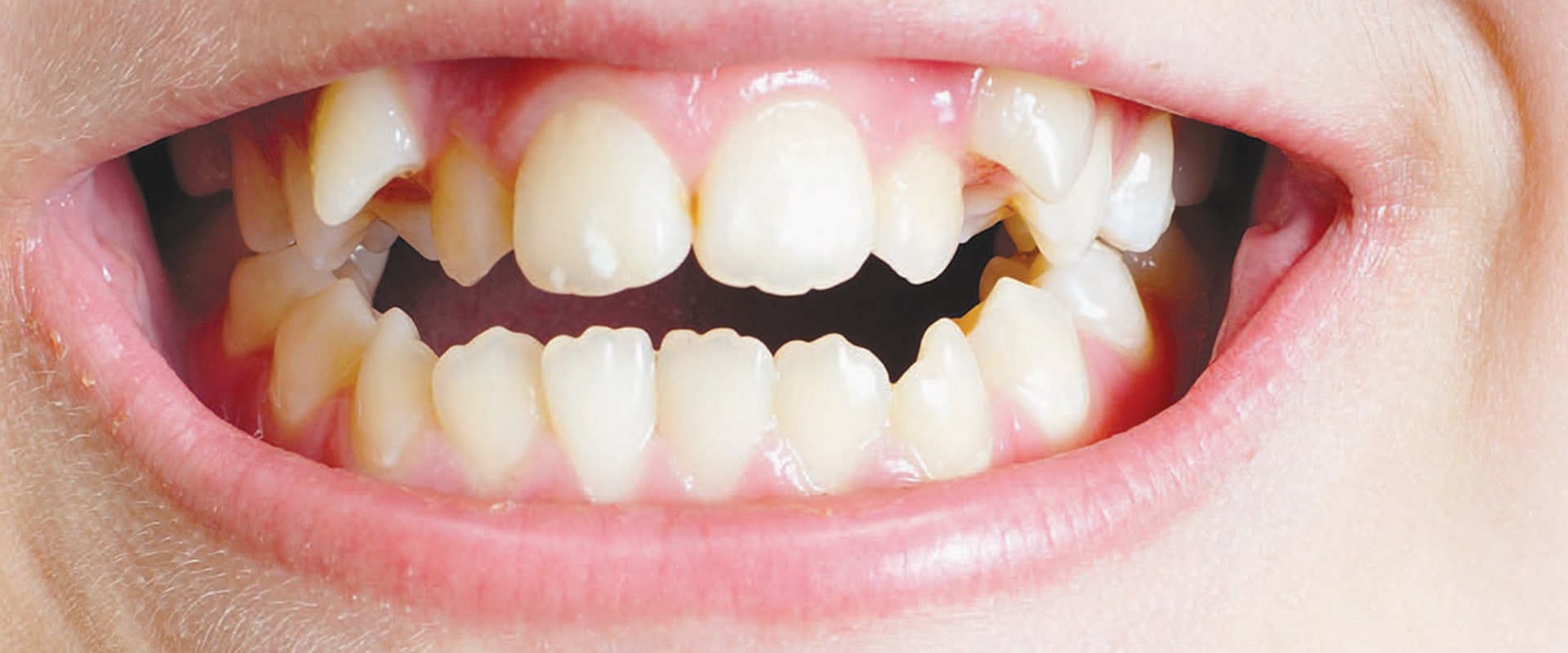 Orthodontic Considerations for Primary and Permanent Bicuspids