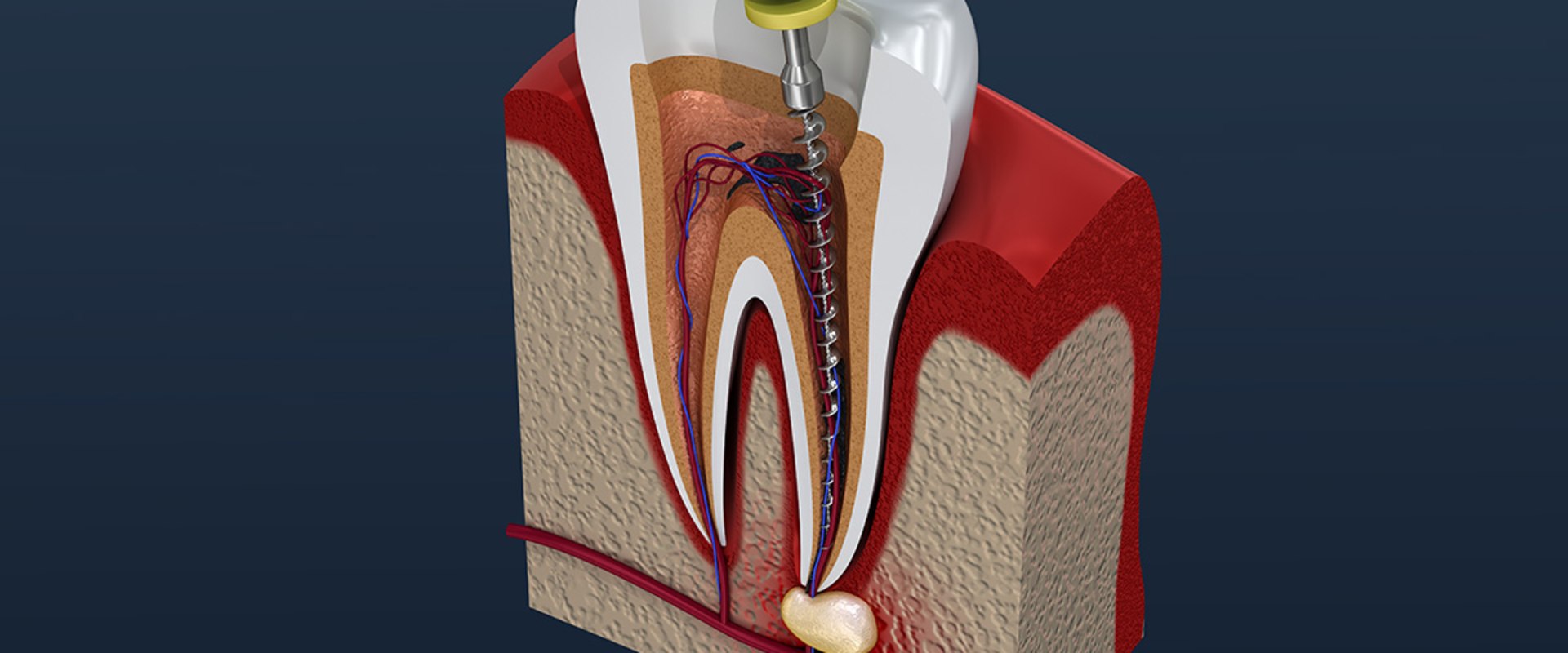 What Happens When a Tooth Infection Reaches the Bone?